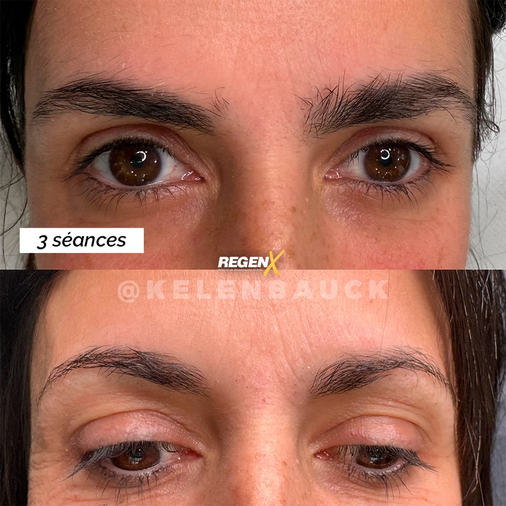 Le protocole RegenX : une alternative aux techniques de microblading et ...